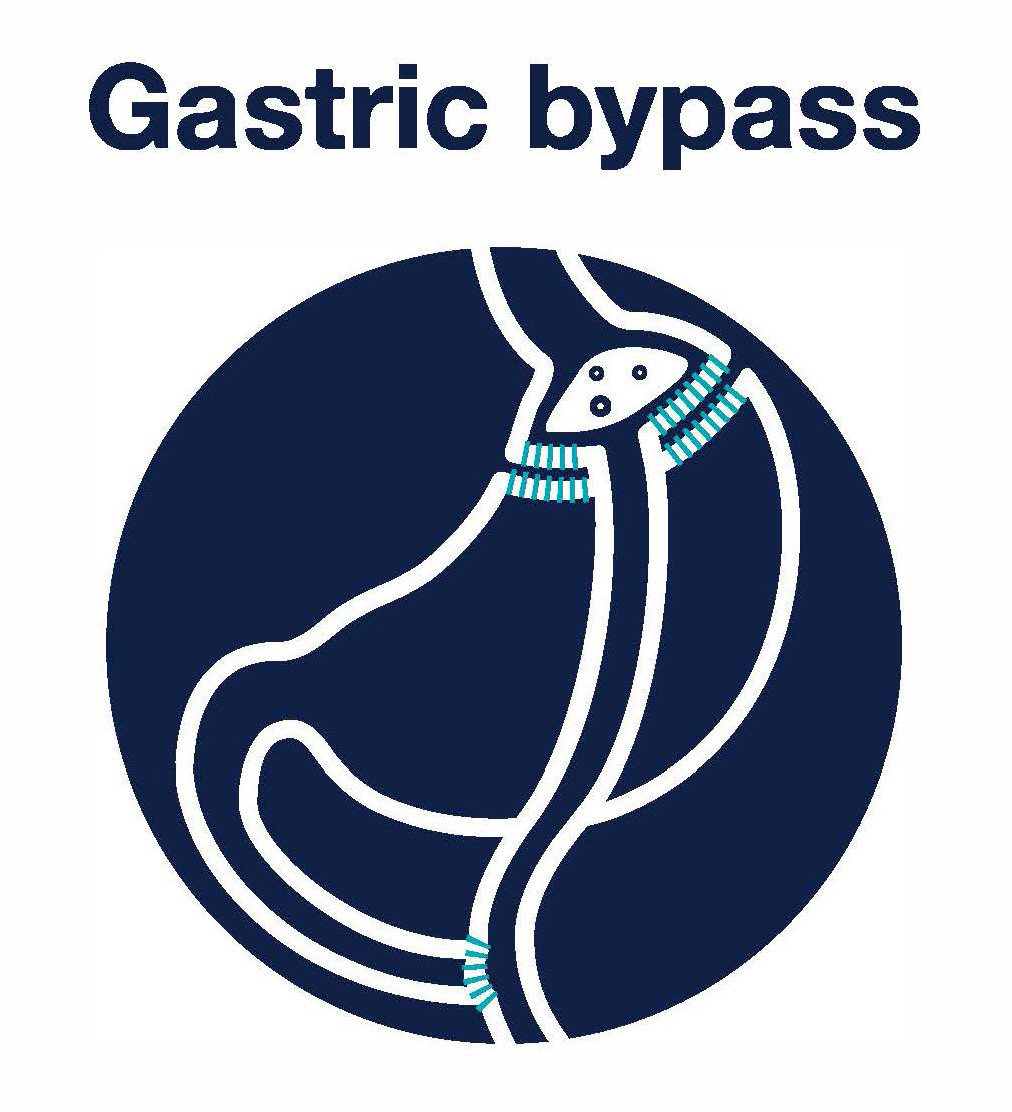 Laparoscopic Gastric Bypass | Vascular Surgery Integrated Residency