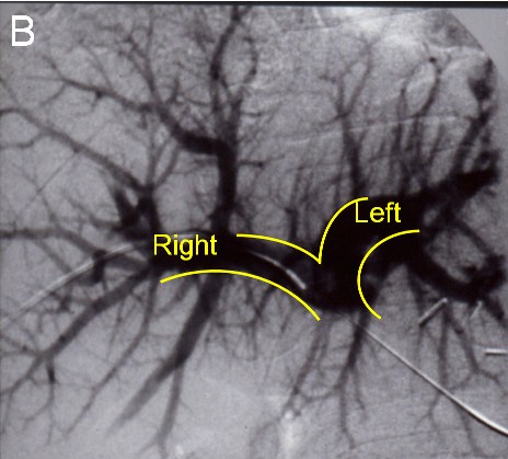 Portal Vein Embolization (PVE) | Vascular Surgery Integrated Residency
